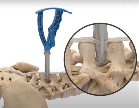 LinQ™ SI Joint Stabilization System - Shore Spine & Pain