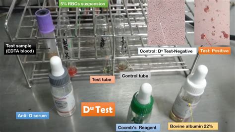 Image result for Du Test Procedure