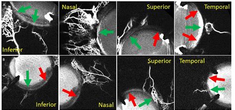 Image result for Aqueous Humor Outflow