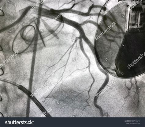 Image result for Normal Coronary Angiogram