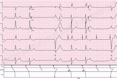 Image result for PR Interval ECG