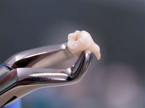 Surgical Tooth Extraction - Vinoda Dental