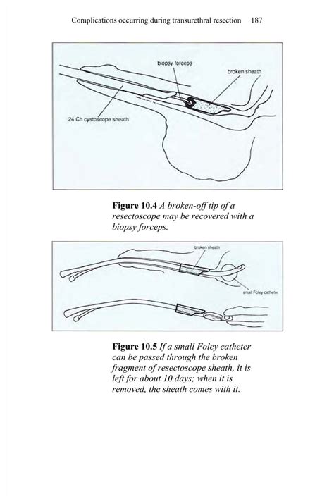 Image result for Transurethral Procedure