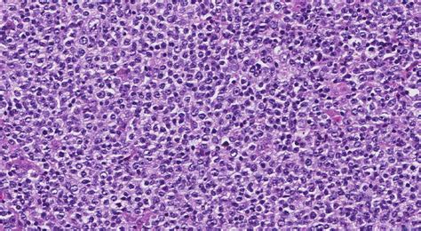 Image result for Diffuse Large Cell Lymphoma