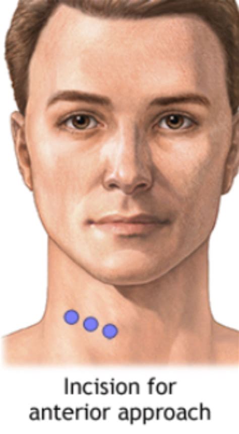 Image result for ACDF Surgery Is Serious