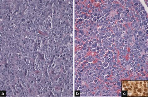 Image result for Diffuse Large Cell Lymphoma