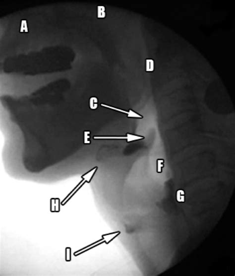 Image result for VFSS Procedure