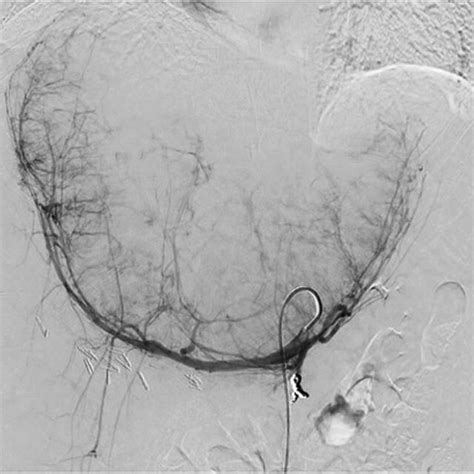 Image result for Angiogram with Embolization