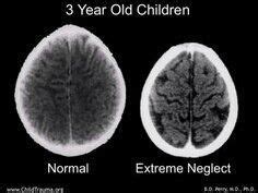 Image result for Developmental Trauma Bruce Perry