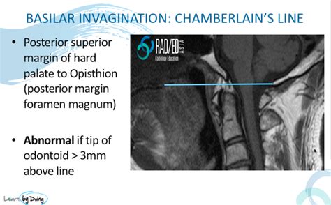 Image result for X-Rays for Basilar Invagination