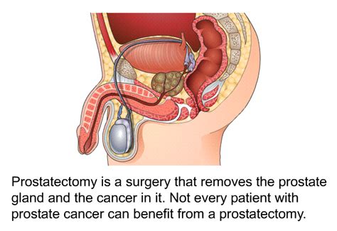 Image result for Prostatectomy Surgery Procedure