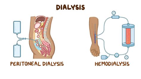 Image result for Dialysis Explained