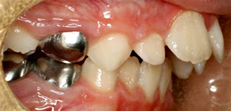 Image result for Wisdom Tooth Overlap