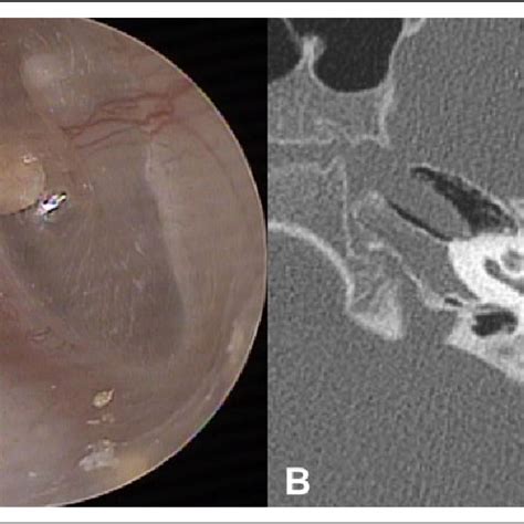 Image result for Incus On-Ear Model