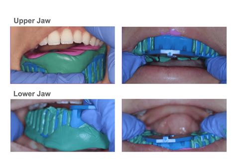 Image result for Impression Procedure