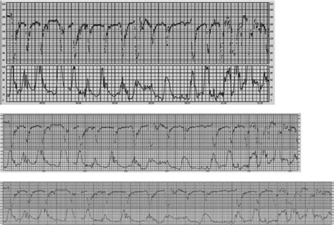 Image result for Variable Decelerations