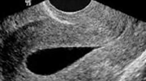 Image result for Watch Embryo Transfer