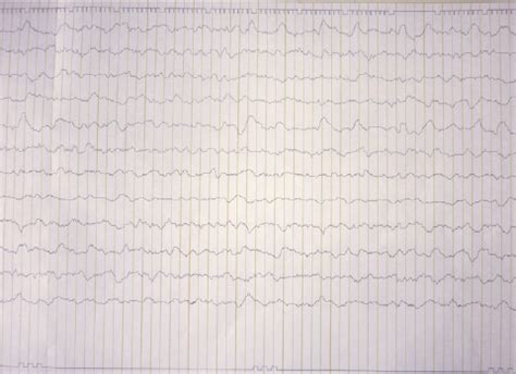 Image result for Extrapyramidal Rigidity Icon