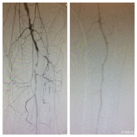 Image result for Peripheral Angiogram