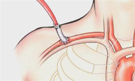 Image result for Type 2 Aortic Dissection