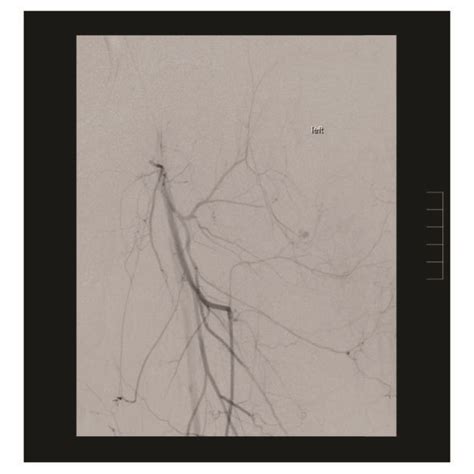 Image result for Left Lower Extremity Angiogram