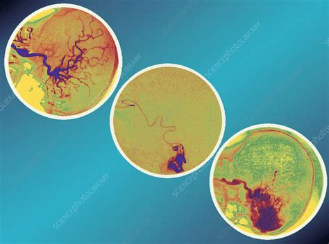 Image result for Embolization Procedure AVM