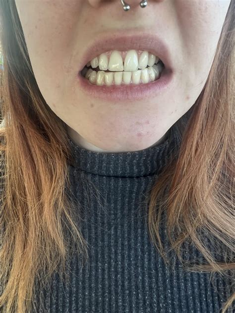 Image result for How to Remove Midline