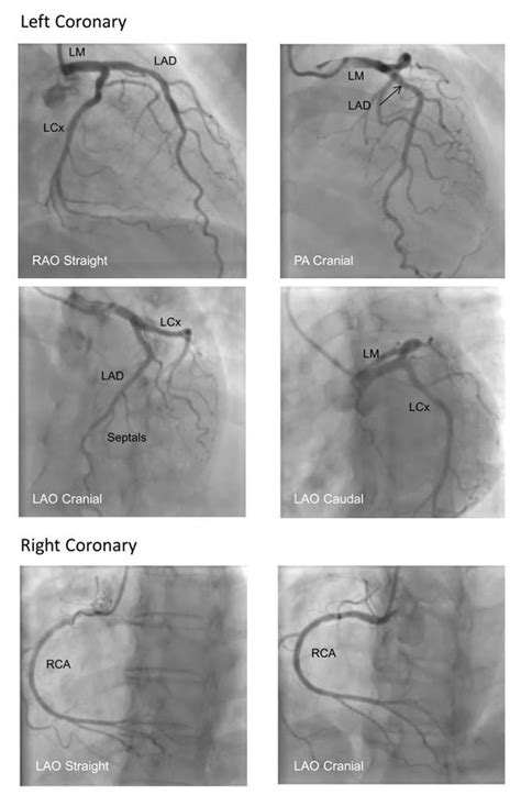 Image result for Heart Block Angiogram