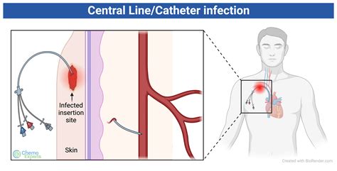 Catheter Line Infection | ChemoExperts