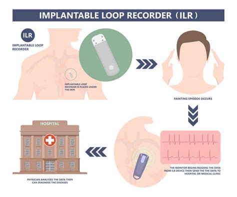 Image result for Loop Recorder Surgery