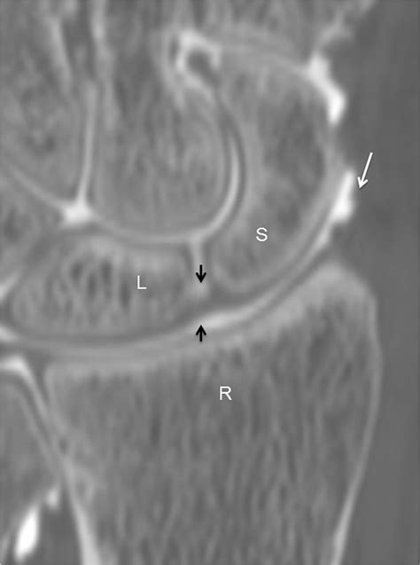 Image result for Wrist Arthrogram