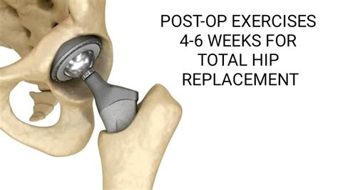 Image result for Hip-Replacement Post Operative Care
