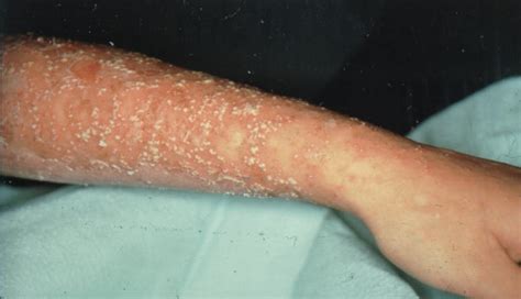 Image result for Types of Pustular Psoriasis