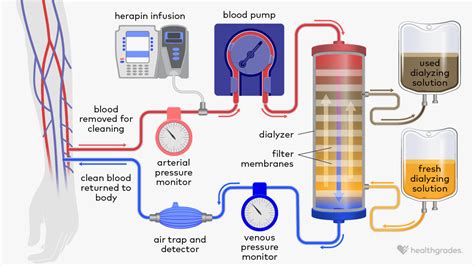 Image result for Dialysis Explained