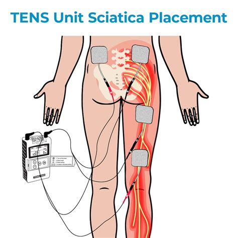 Image result for Tens Machine Sciatica