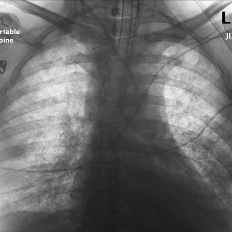 Image result for Inverted Chest Fly