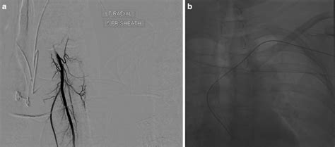 Image result for Angiogram Radial