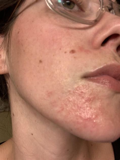 Image result for Seb Derm