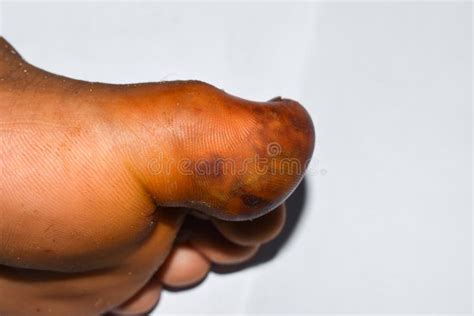 Image result for Cellulitis Toe