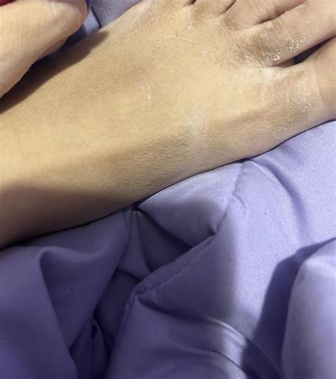 Image result for Scleroderma Skin