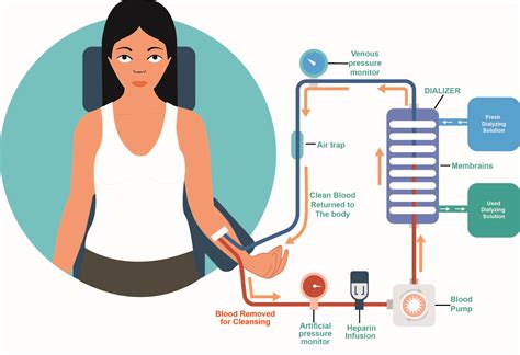 Image result for Dialysis Explained