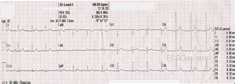 Image result for Normal EcG