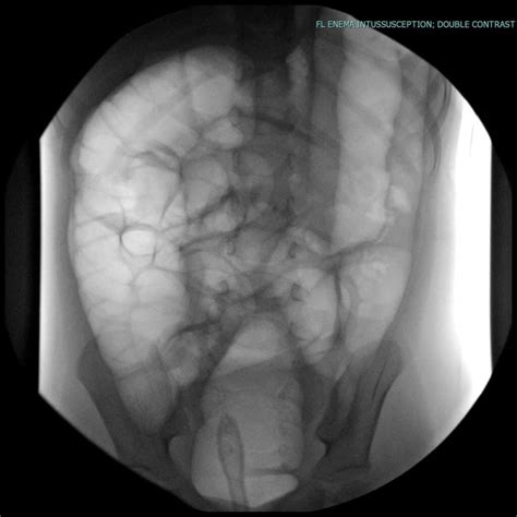 Image result for Pronounce Intussusception