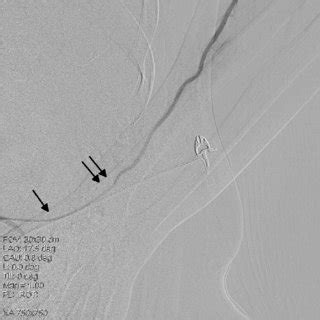 Image result for Angiogram Radial