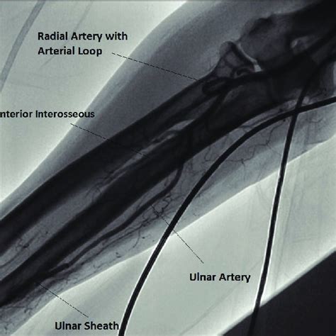 Image result for Radial Loop Angiogram