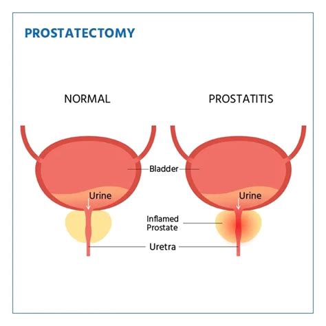 Image result for Prostatectomy Surgery Procedure