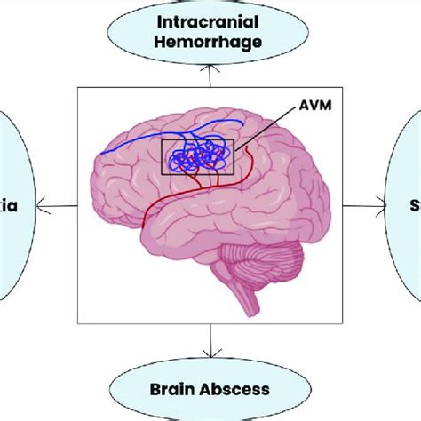 Image result for AVM Recovery