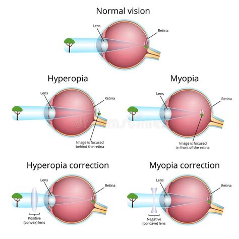 Image result for Vision Defects Myopia