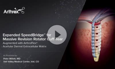 Image result for SpeedBridge Rotator Cuff