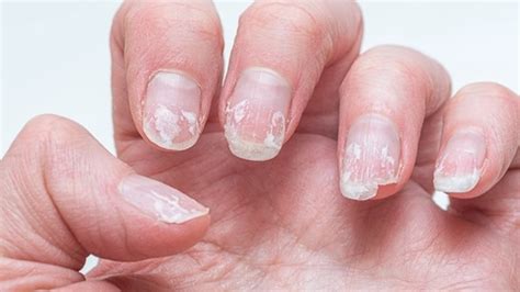 Image result for Help for Splitting Nails Shea Butter
